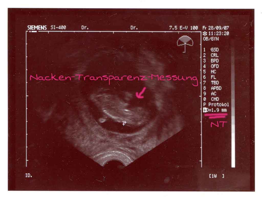Elfte Schwangerschaftswoche : Belly-book